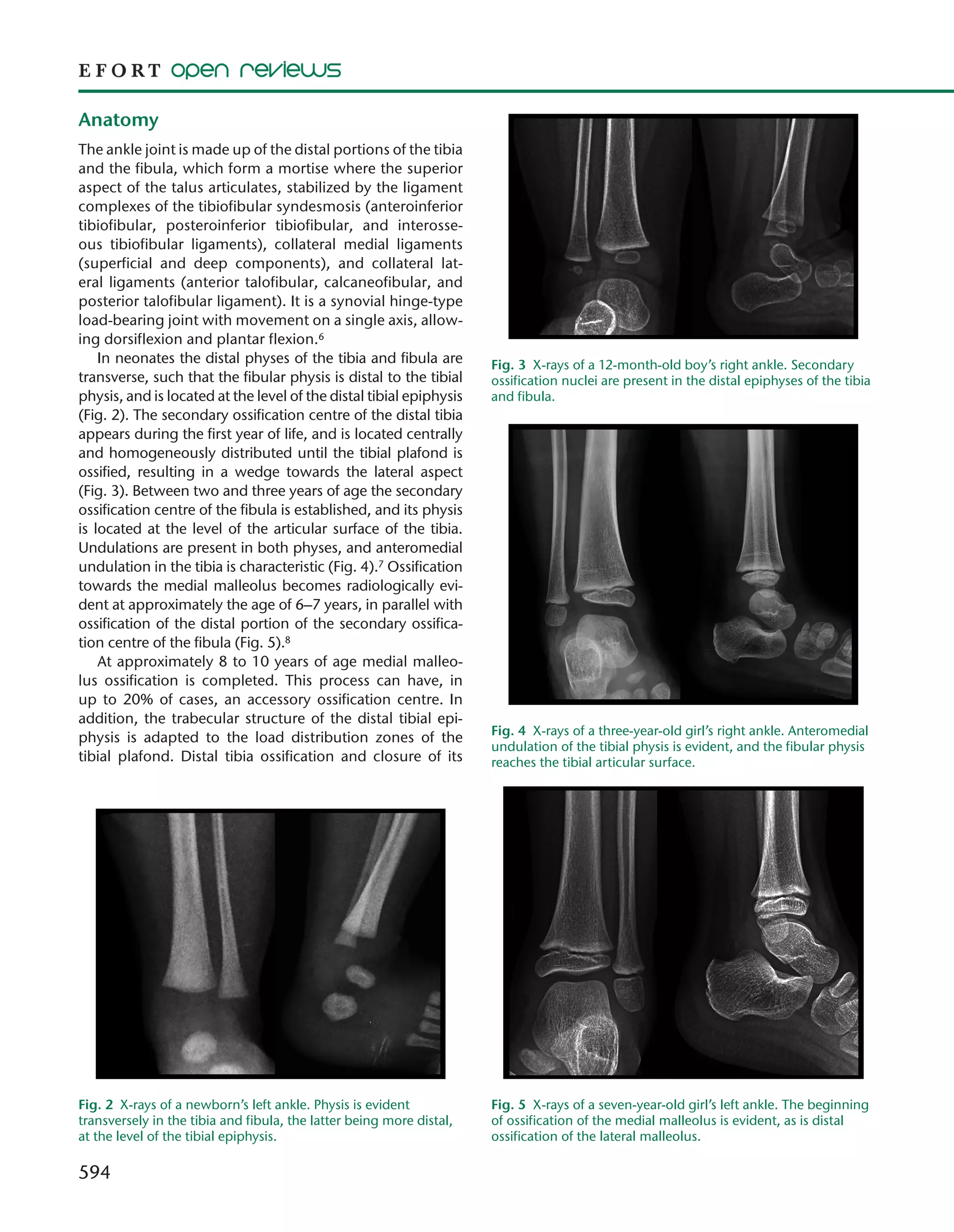 Ankle fractures in children 2021 | PDF