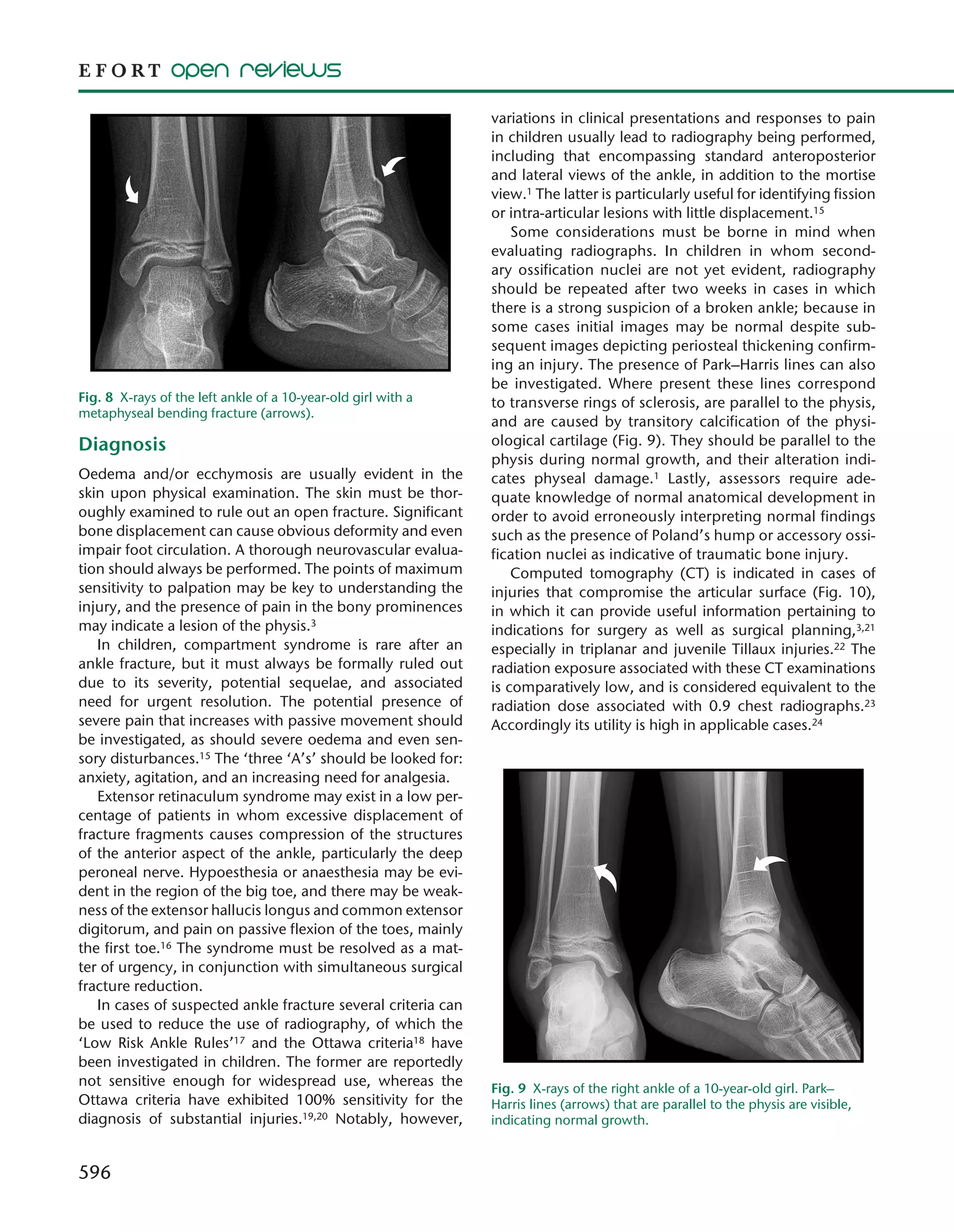 Ankle fractures in children 2021 | PDF
