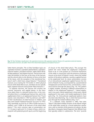 Ankle fractures in children 2021 | PDF