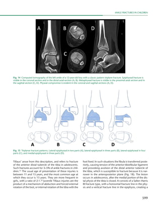 Ankle fractures in children 2021 | PDF