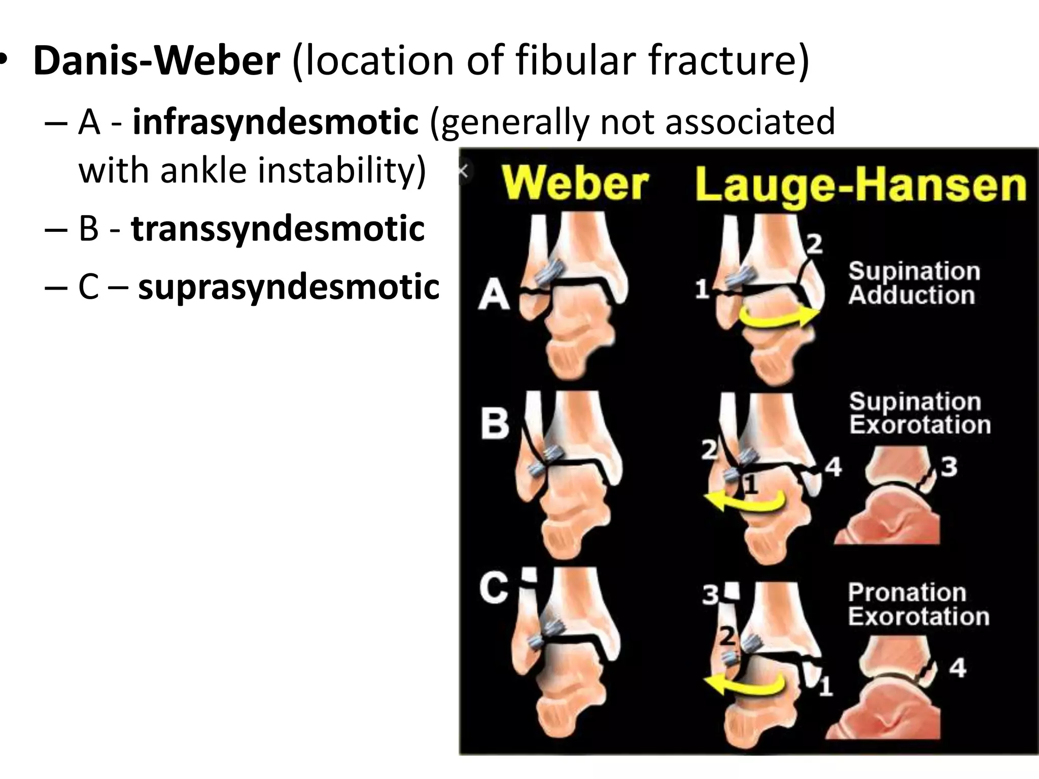 Ankle fractures | PPTX