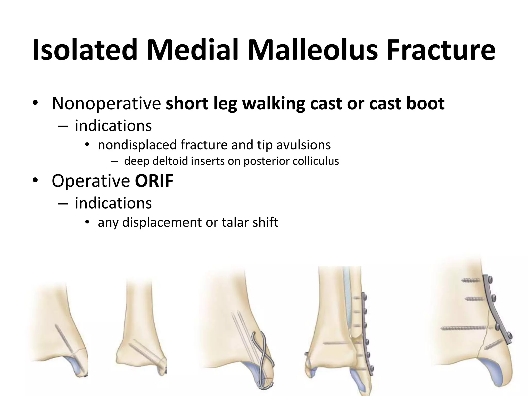 Ankle fractures | PPTX