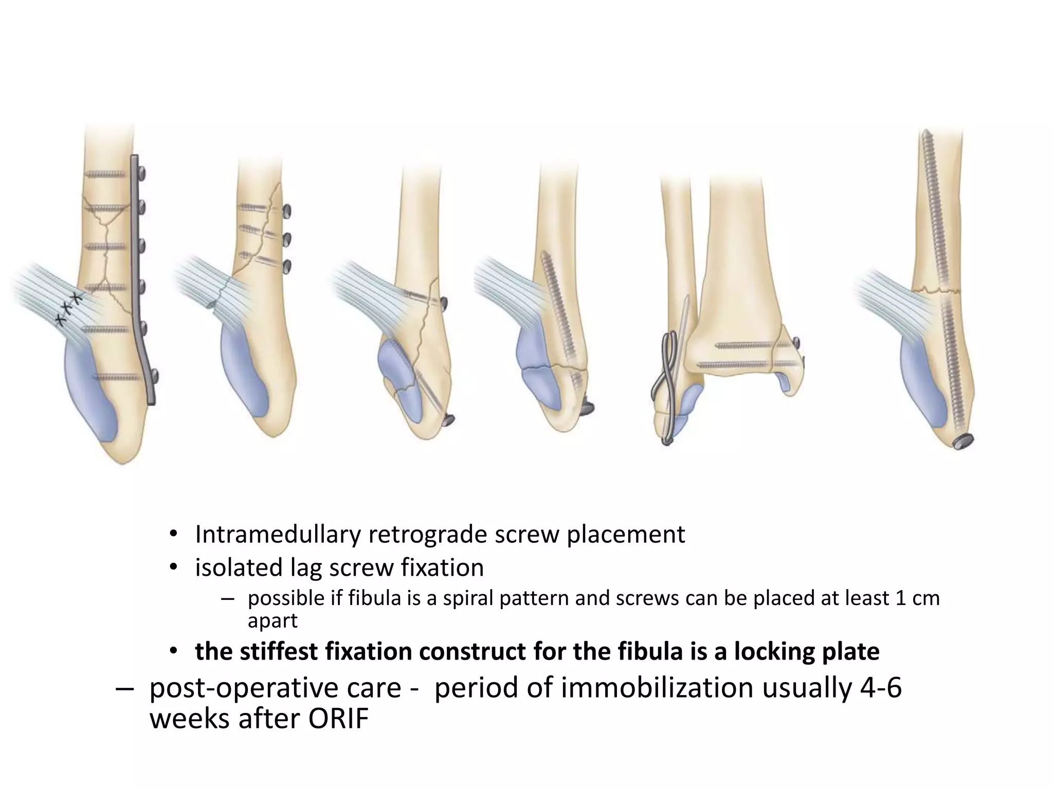 Ankle fractures | PPTX
