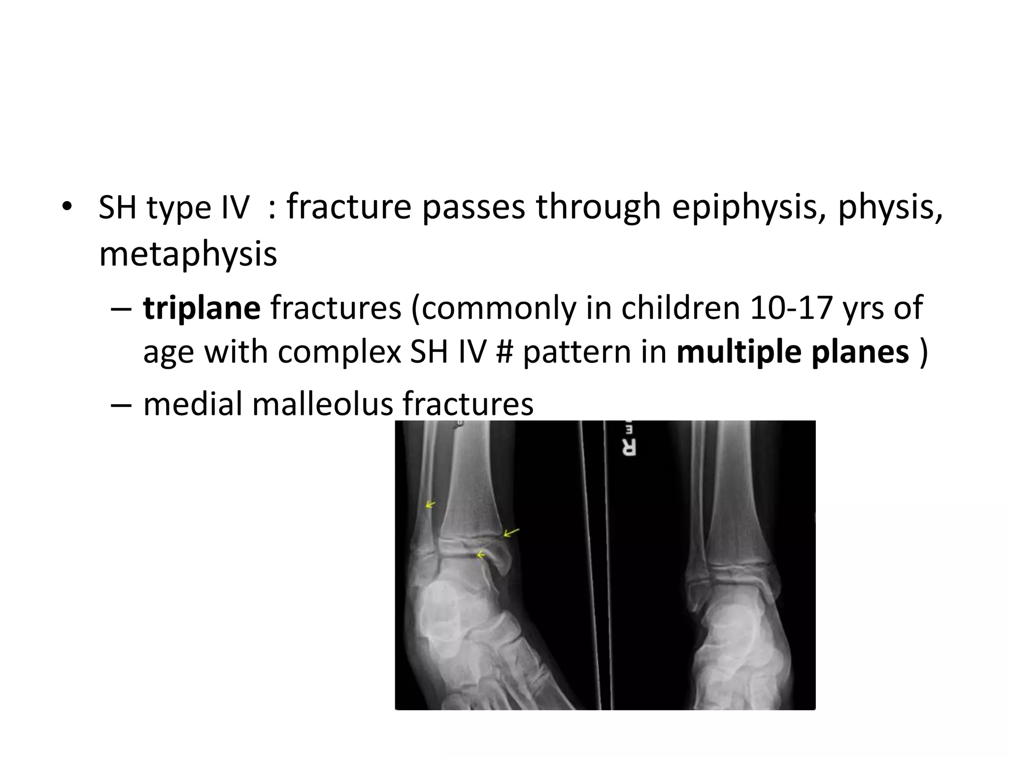 Ankle fractures | PPTX