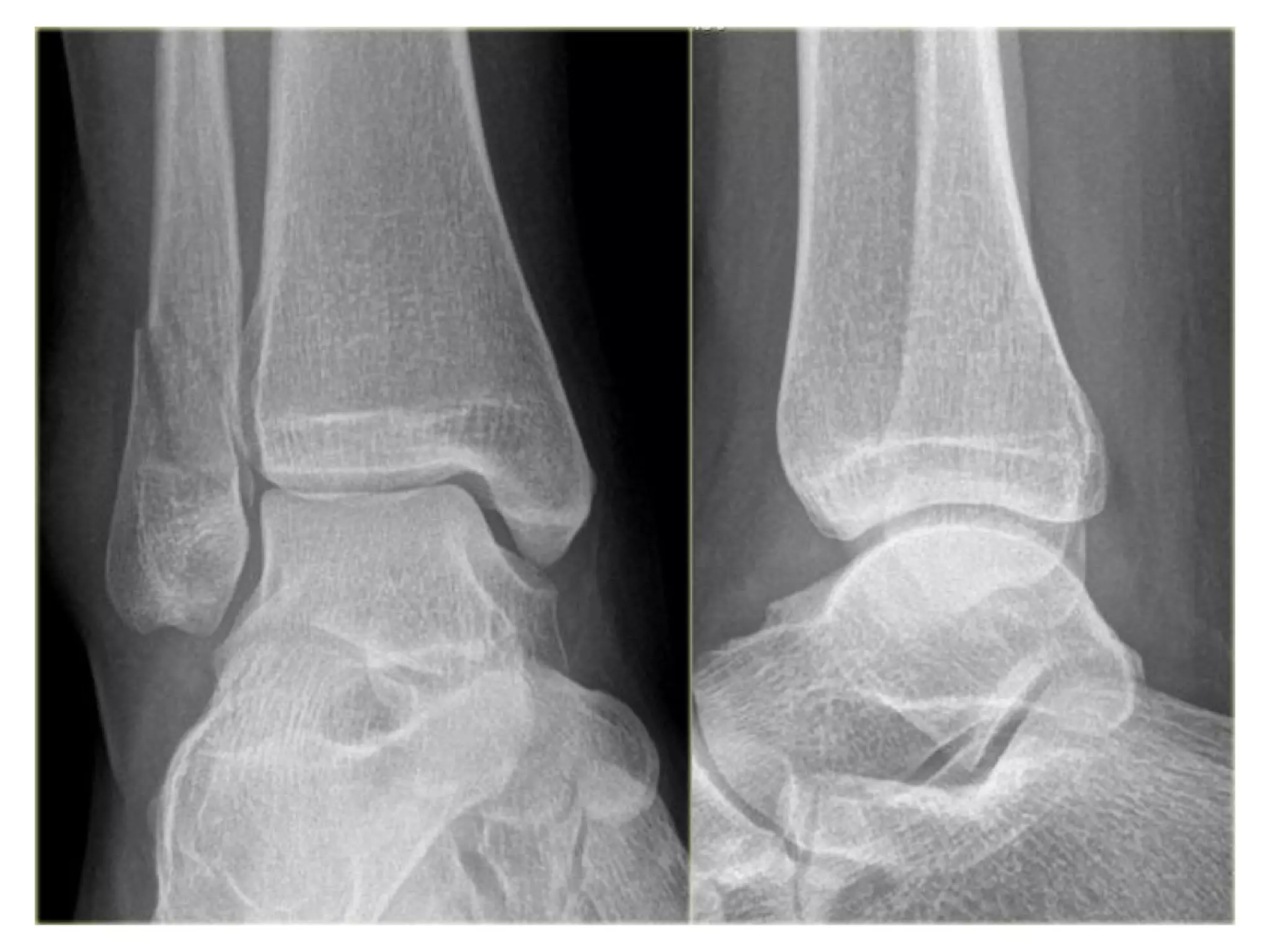 Ankle Fracture Weber B Xray 2019 Ppt