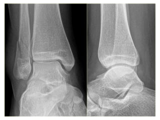 Ankle fracture weber b xray 2019 | PPT