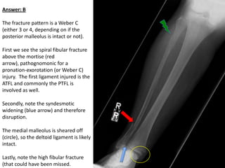 Ankle fractures question/image bank | PPTX