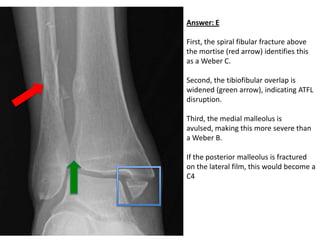 Ankle fractures question/image bank | PPTX