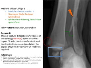 Ankle fractures question/image bank | PPTX