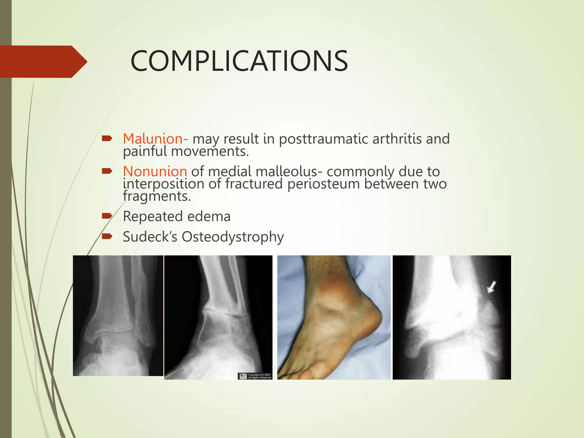 ANKLE_INJURIES.ppt