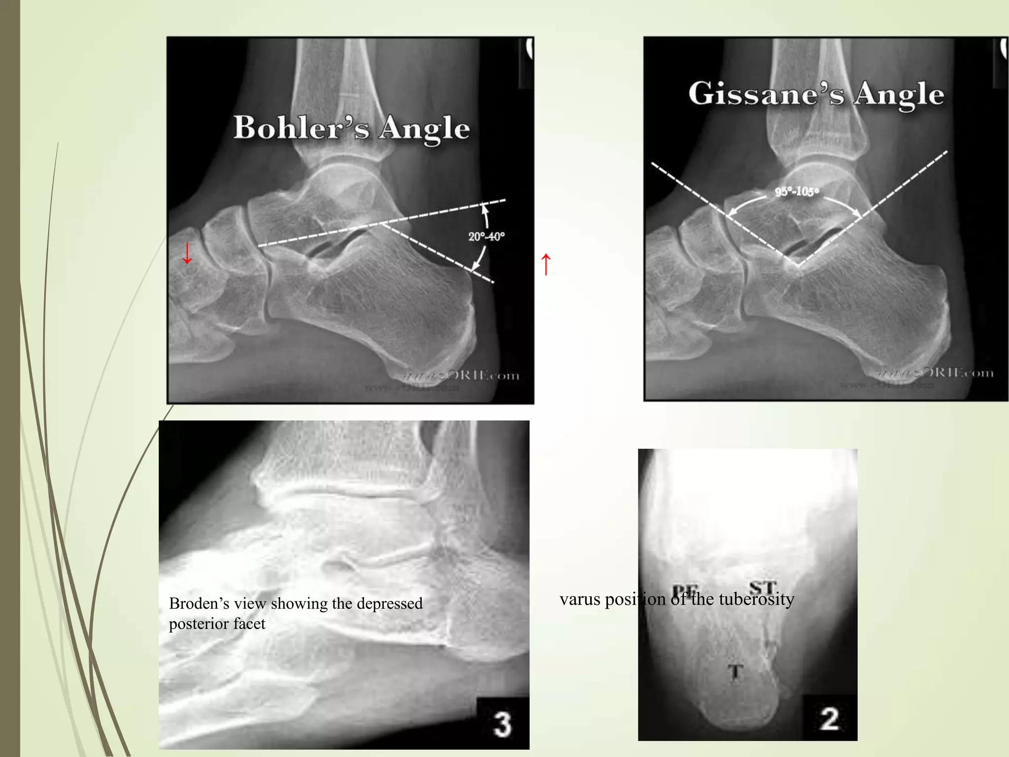 ANKLE_INJURIES.ppt