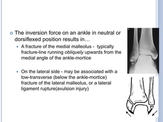 Ankle injuries - Copy.pptx