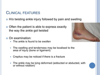 Ankle injuries - Copy.pptx