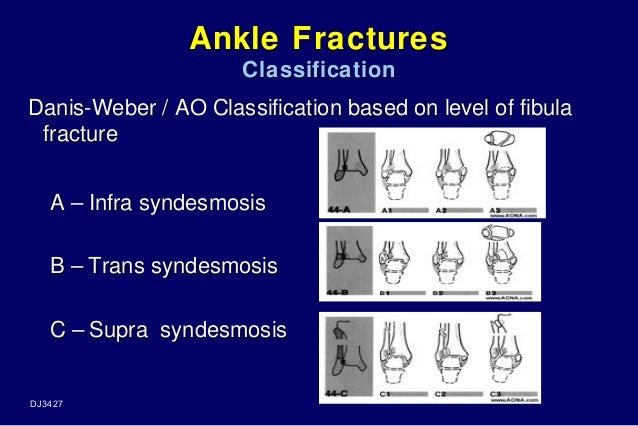 Ankle injury