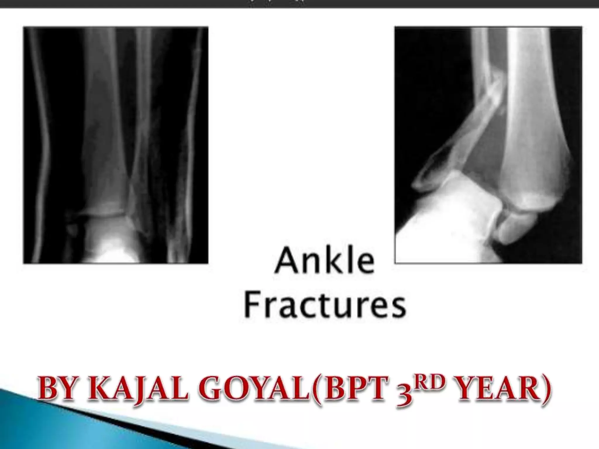 all types of Ankle fracture by kajal | PPTX