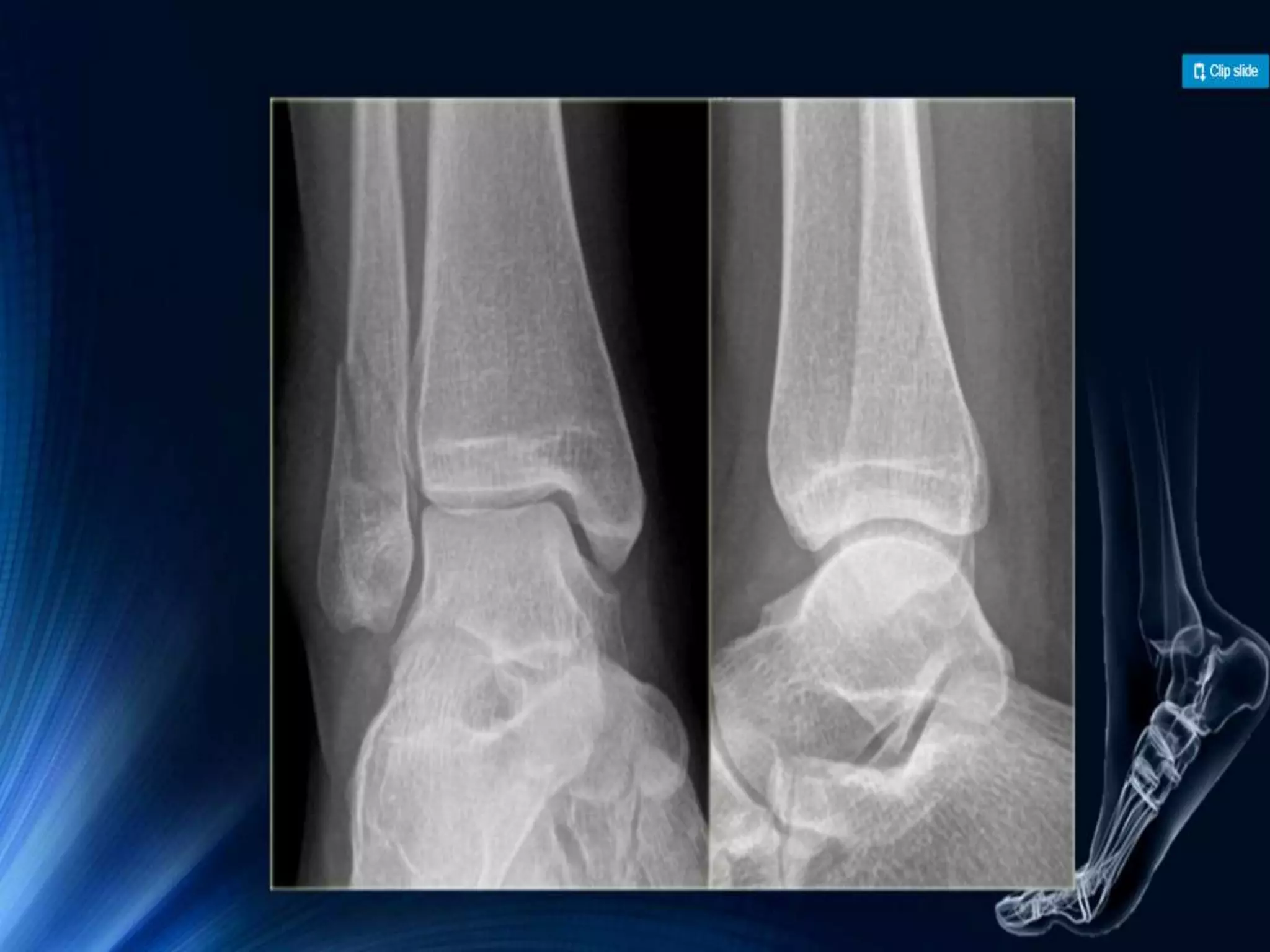 all types of Ankle fracture by kajal | PPTX