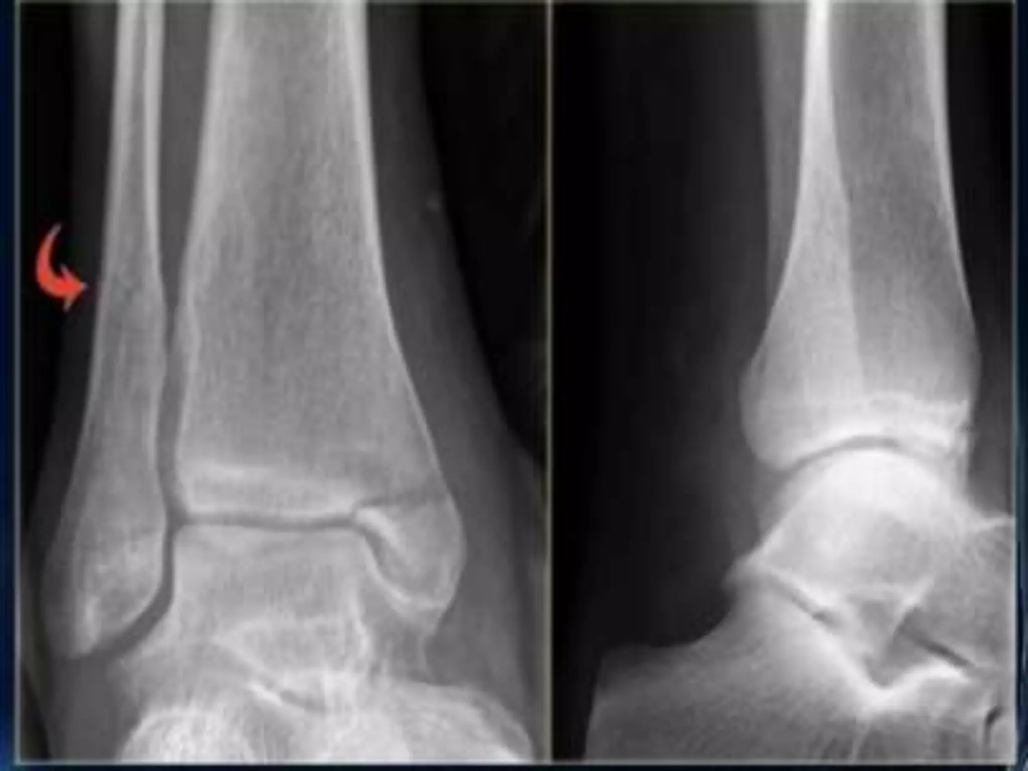 all types of Ankle fracture by kajal | PPTX