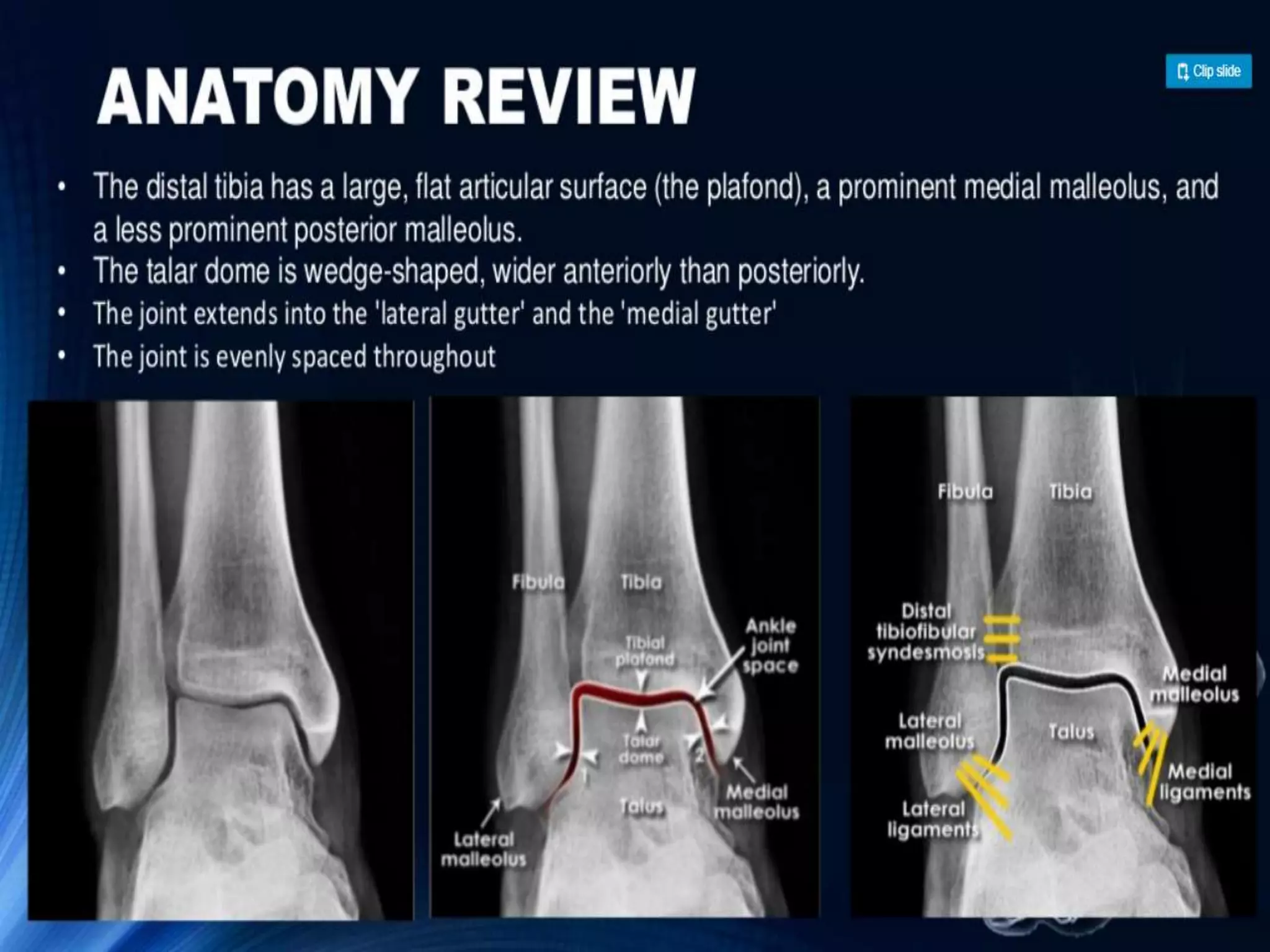 all types of Ankle fracture by kajal | PPTX