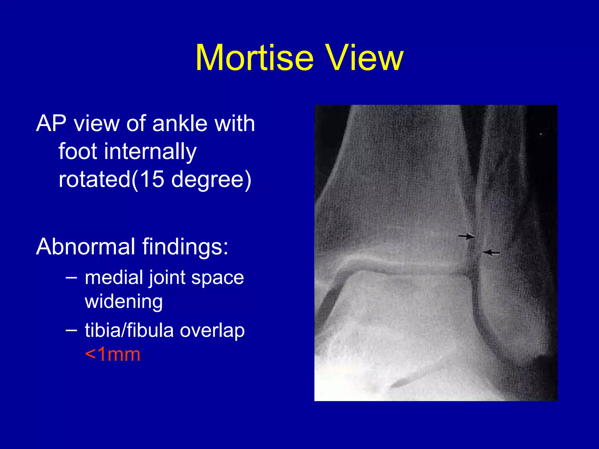 Ankle injury amanj | PPT