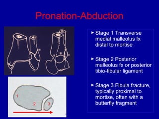 Pronation Abduction Ankle Fracture