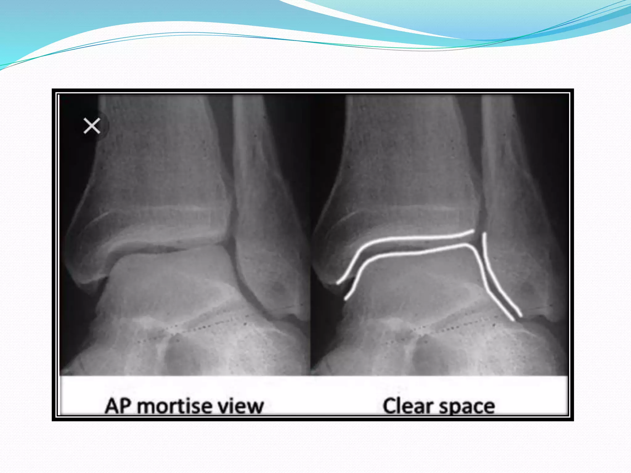 RADIOGRAPHIC VIEWS OF ANKLE JOINT | PPTX