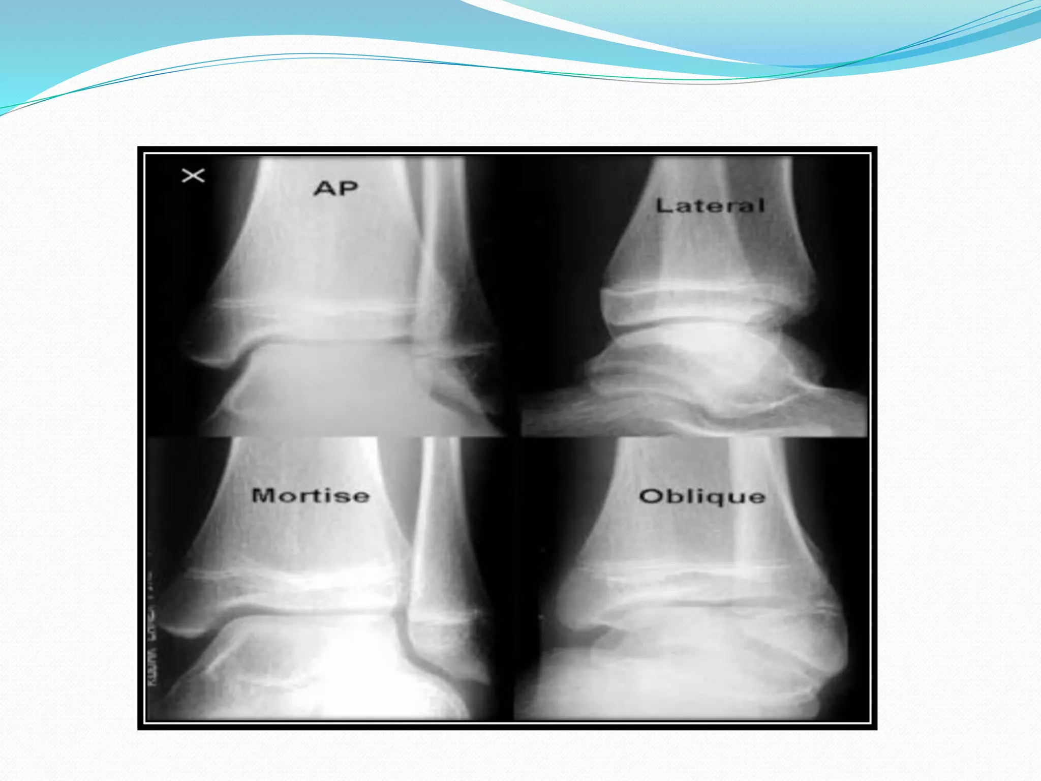 RADIOGRAPHIC VIEWS OF ANKLE JOINT | PPTX