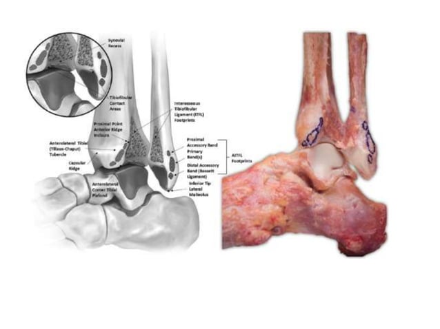 Ankle joint and joints of foot | PPT