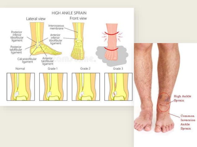 Ankle joint and joints of foot | PPT