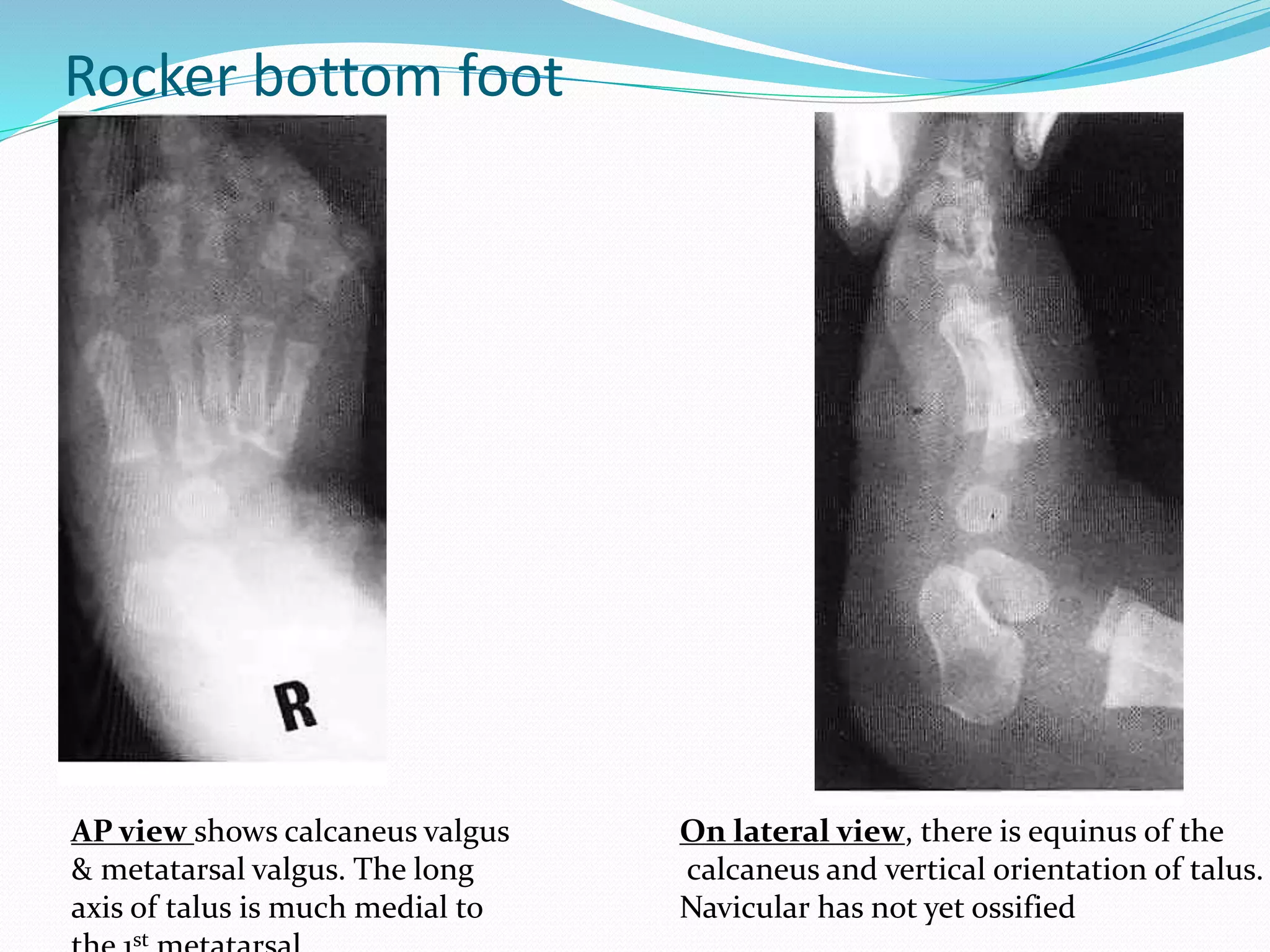 Ankle joint pathology imaging | PPTX