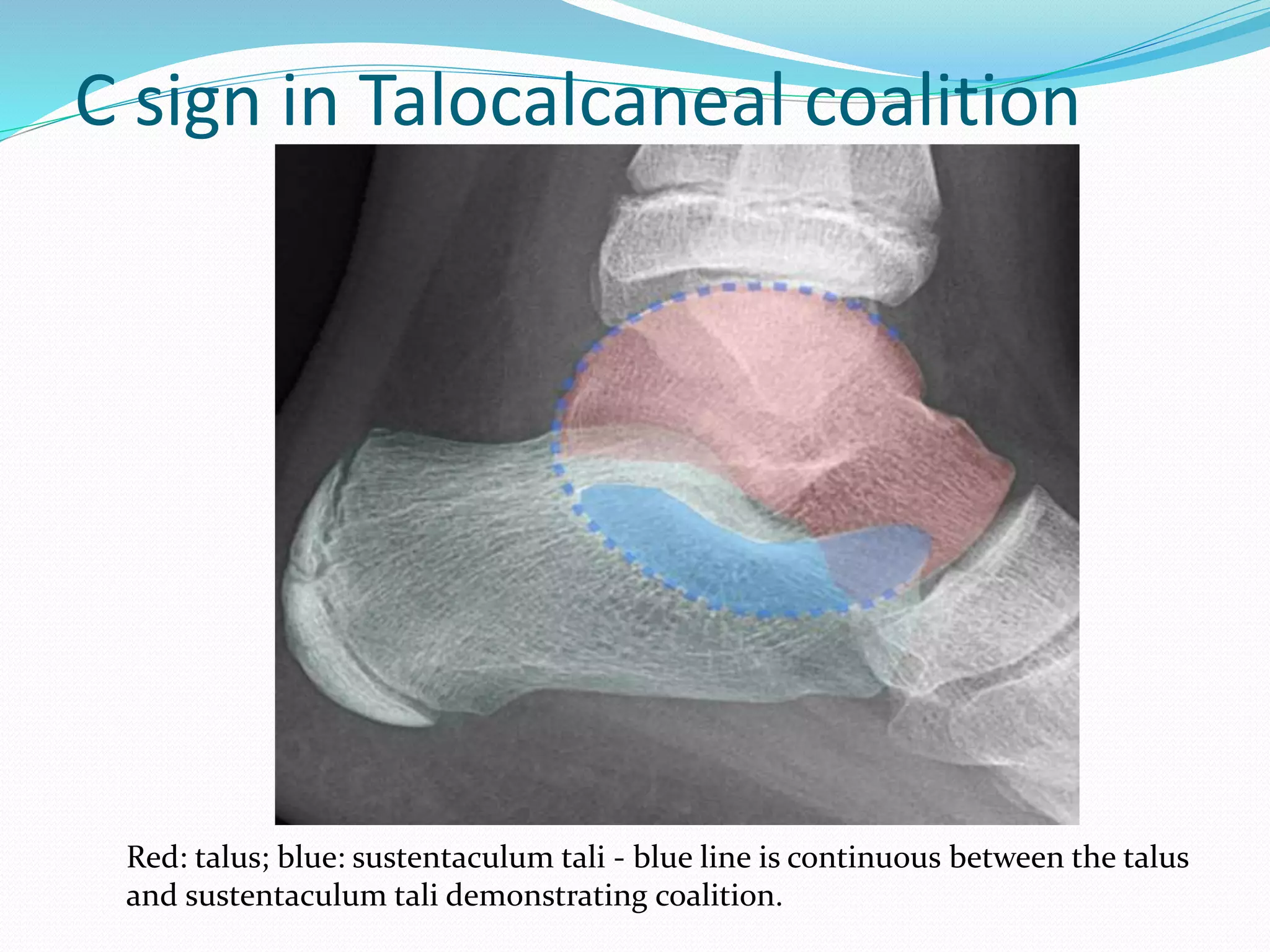 Ankle joint pathology imaging | PPTX