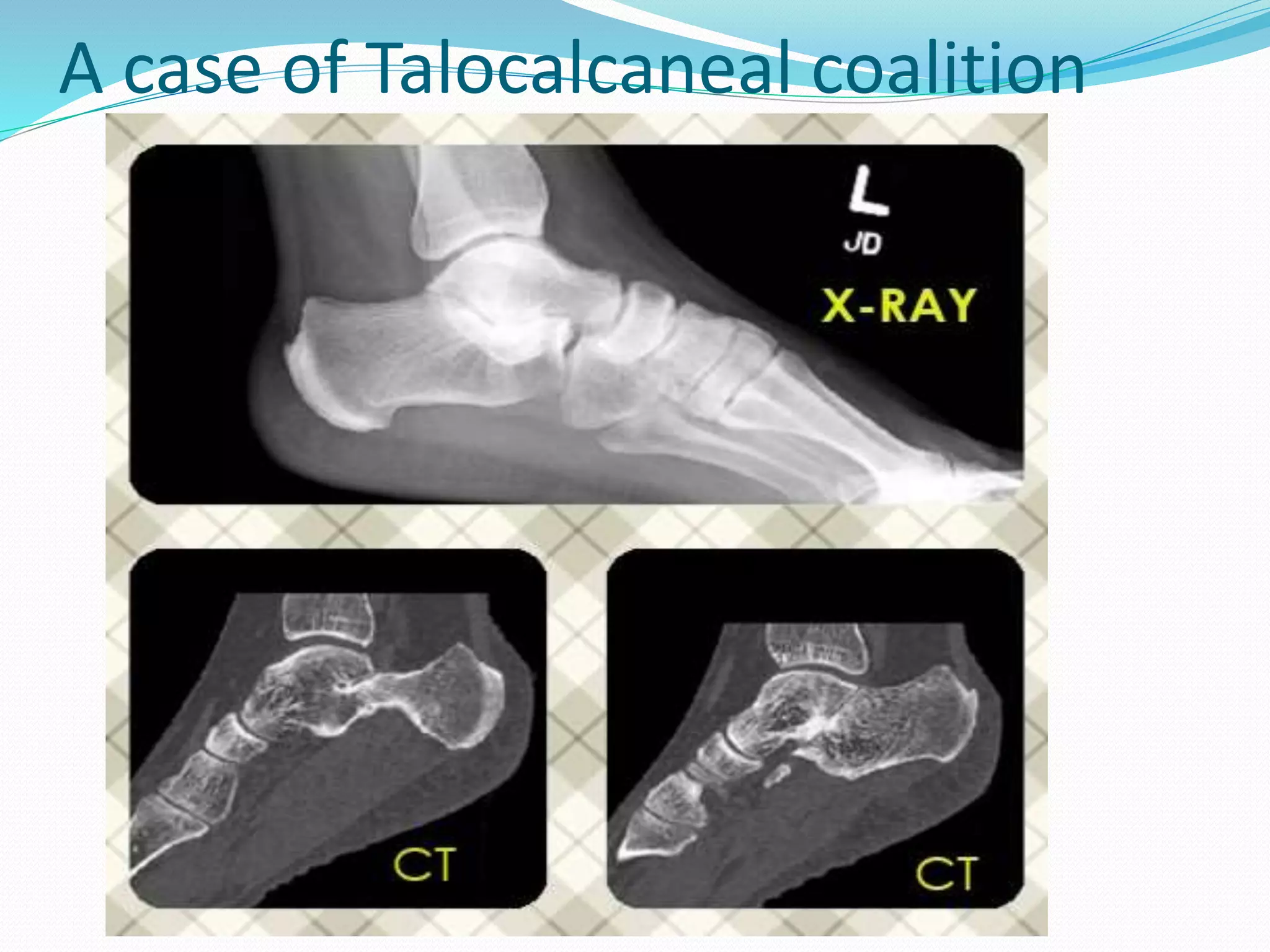 Ankle joint pathology imaging | PPTX