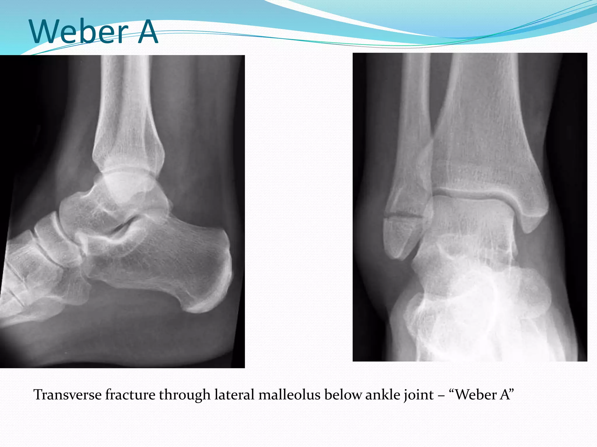 Ankle joint pathology imaging | PPTX