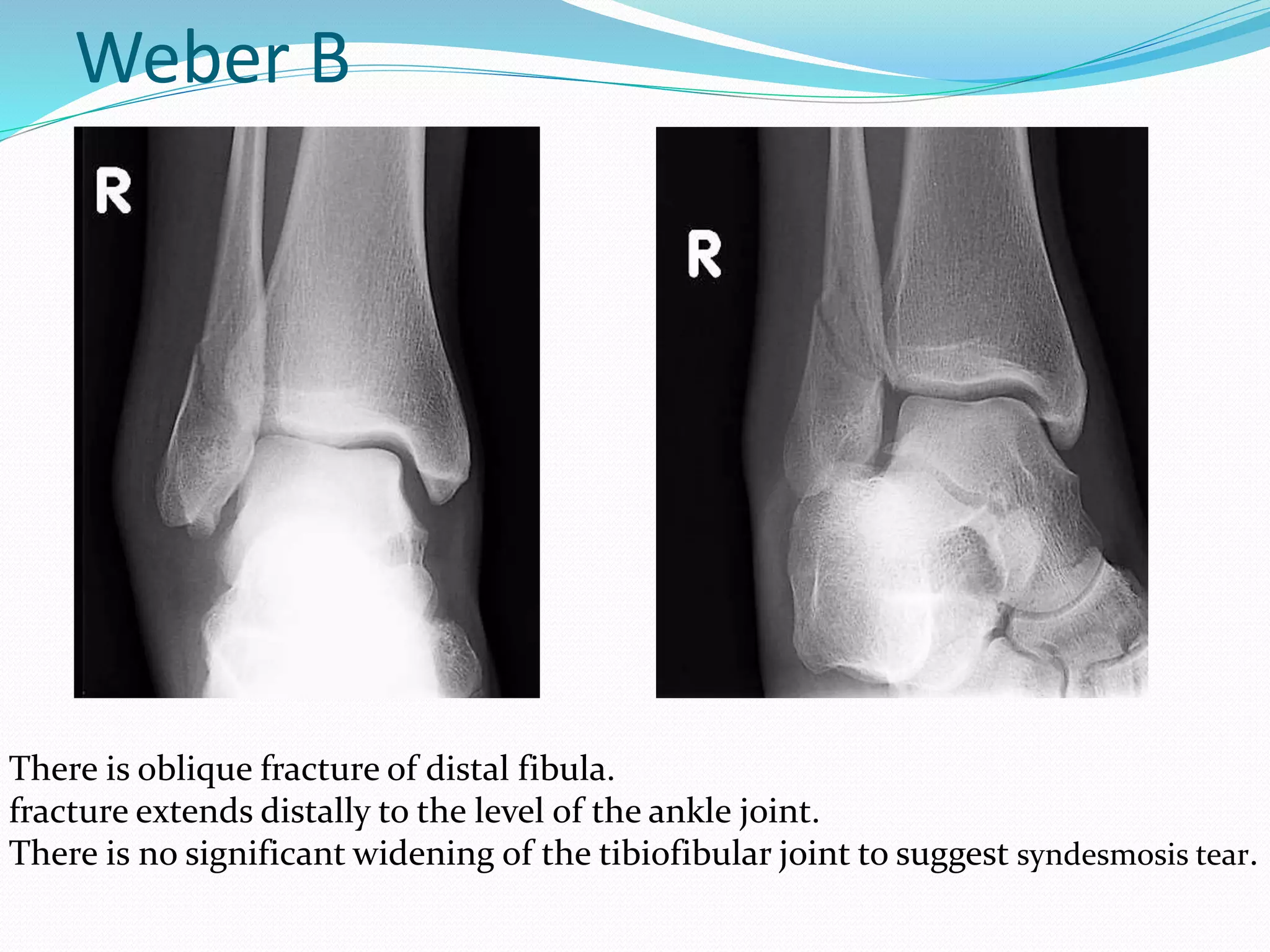 Ankle joint pathology imaging | PPTX
