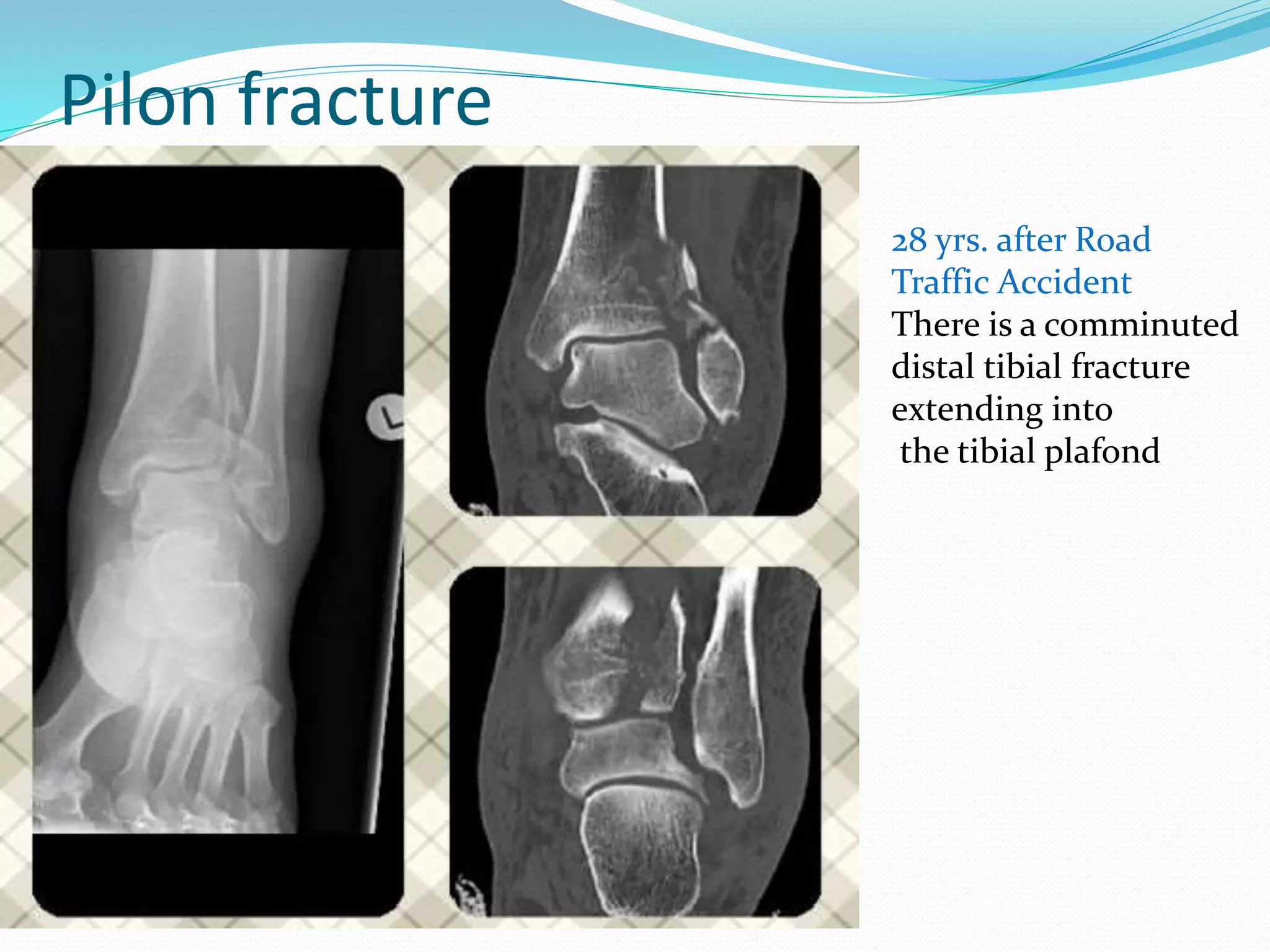 Ankle joint pathology imaging | PPTX