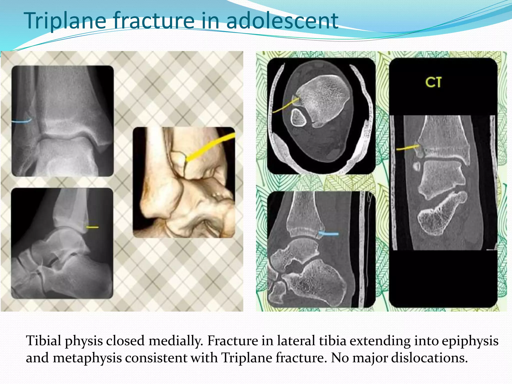 Ankle joint pathology imaging | PPTX