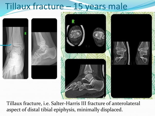 Ankle joint pathology imaging | PPTX