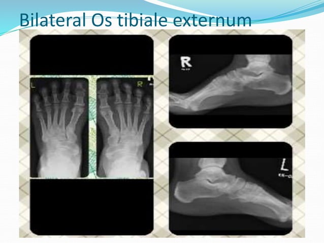 Ankle joint pathology imaging | PPTX