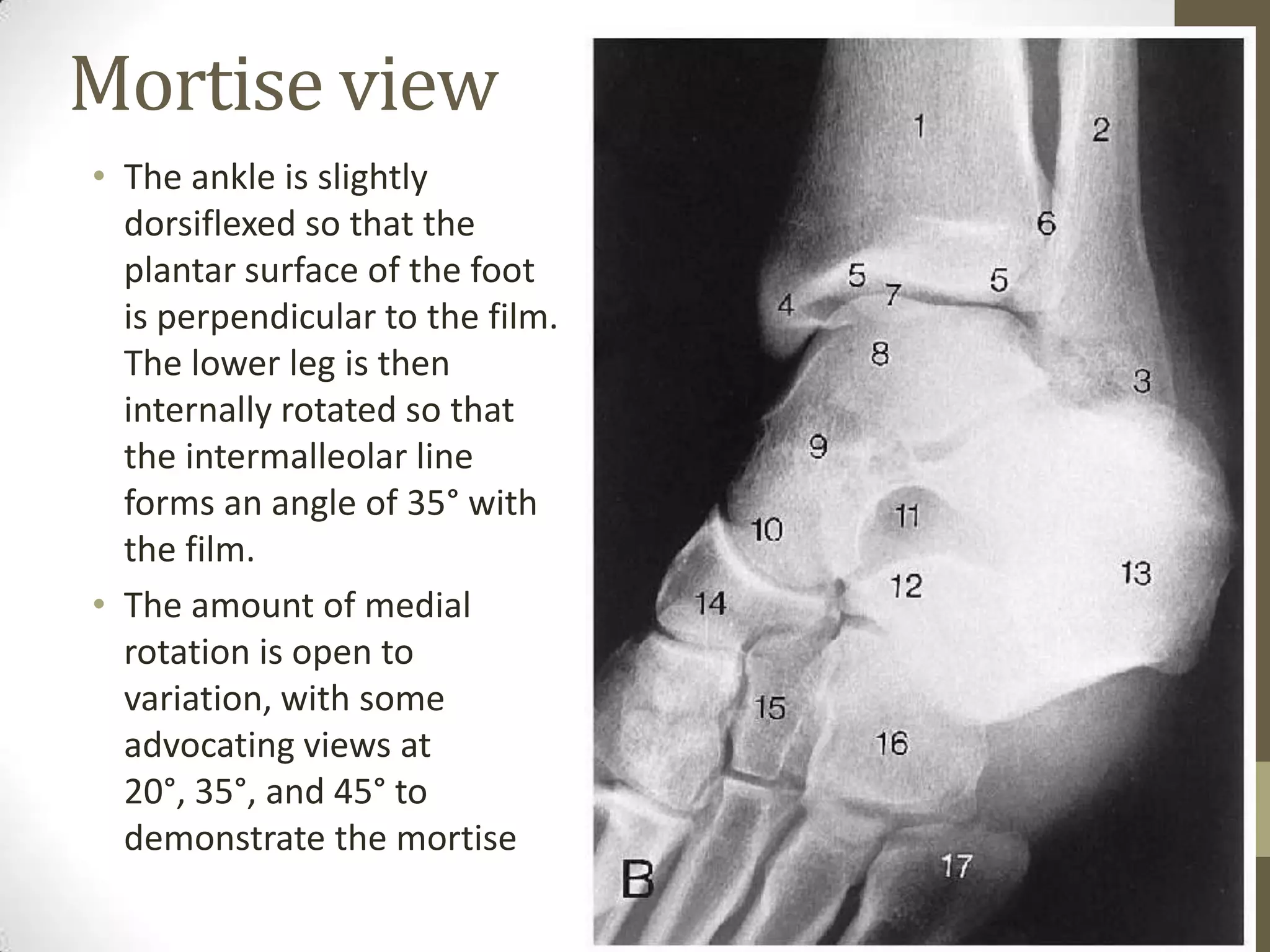 Ankle joint radiography | PPTX | Death, Injury, or Military Conflict ...