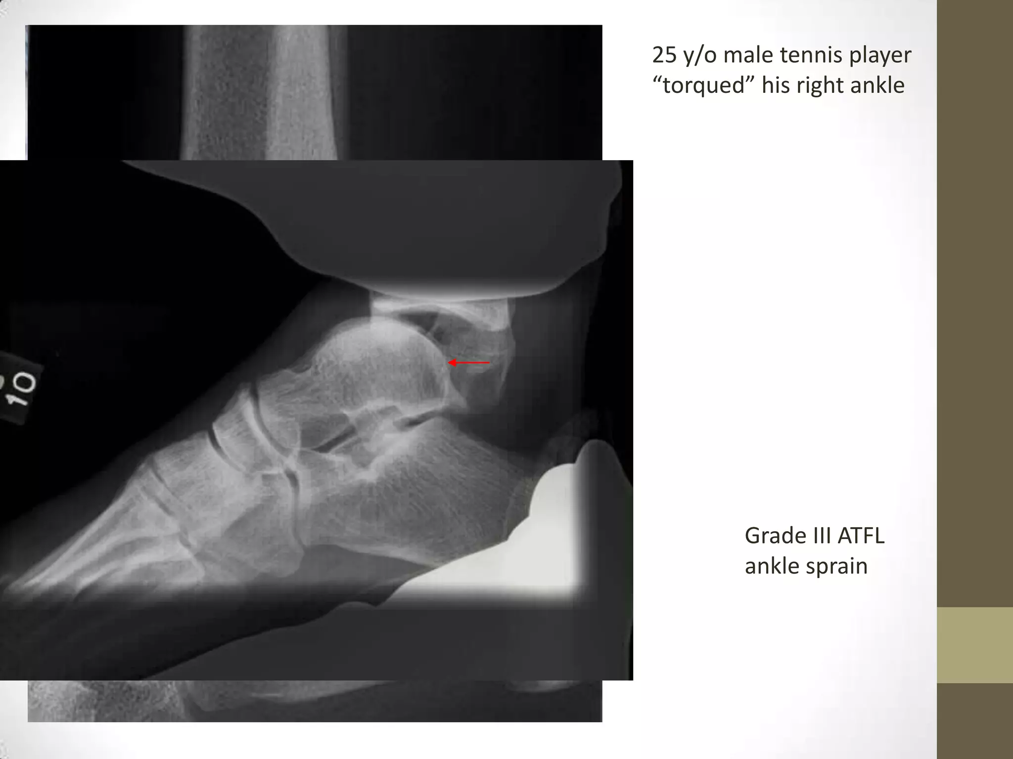 Ankle joint radiography | PPTX