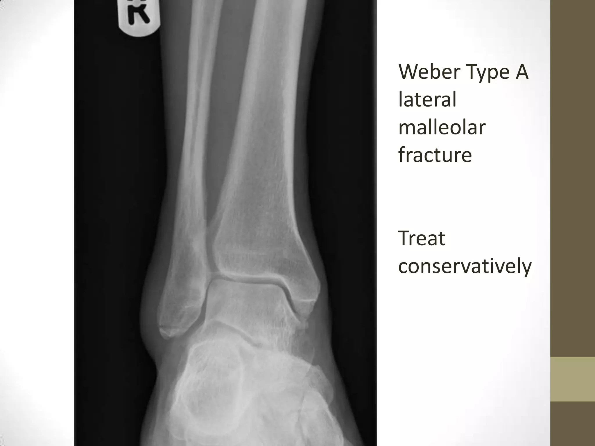 Ankle joint radiography | PPTX