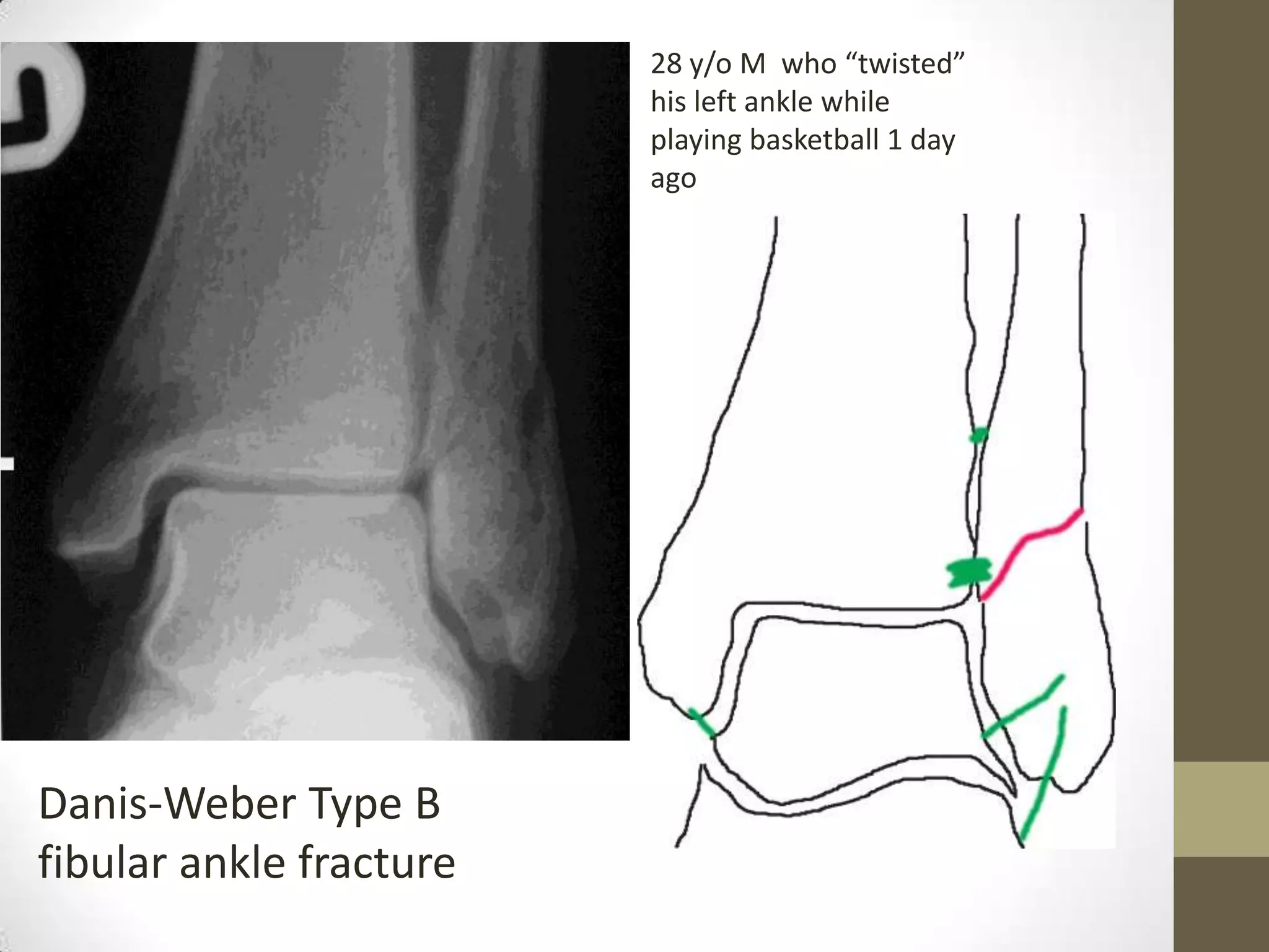 Ankle joint radiography | PPTX
