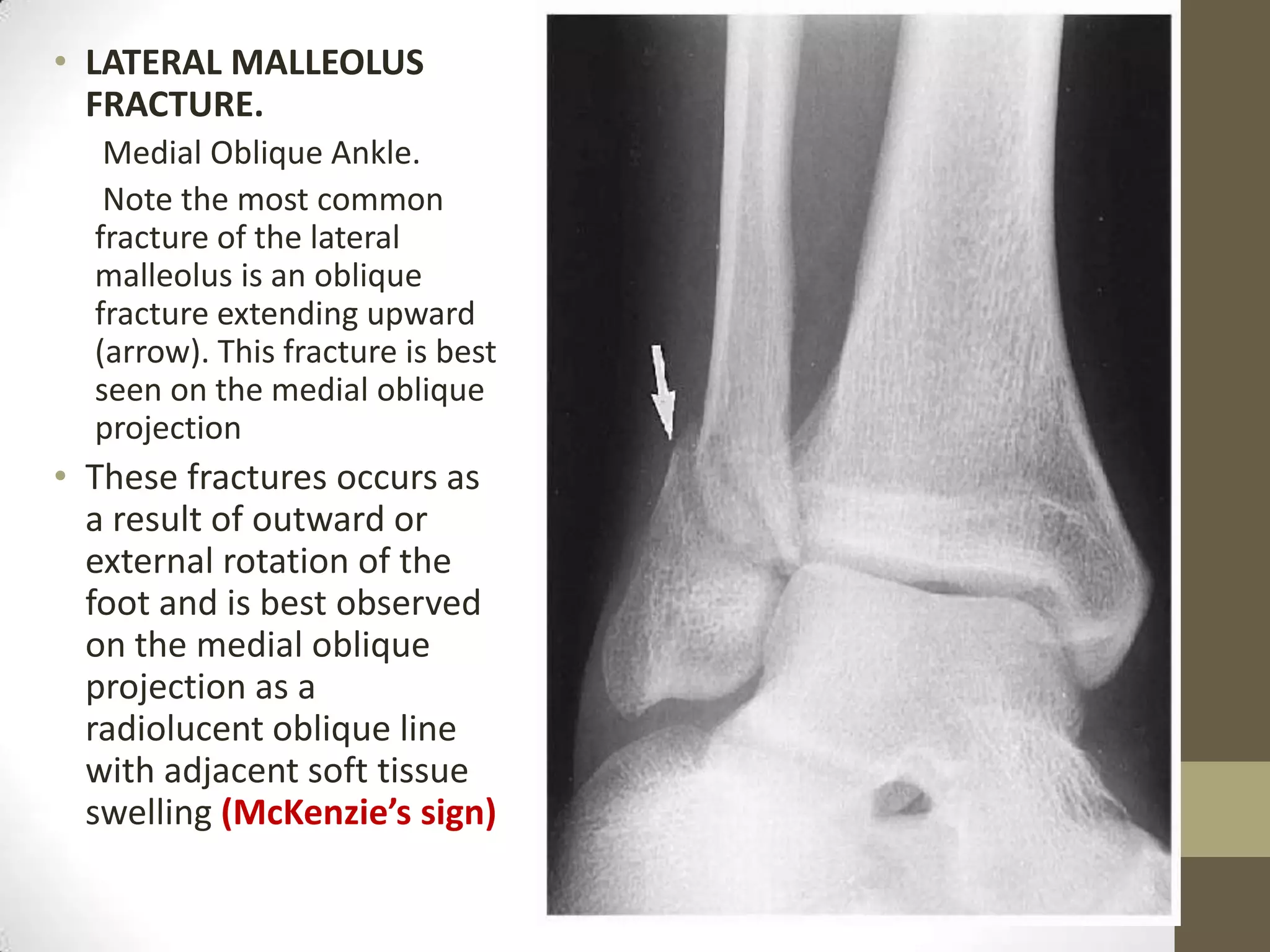 Ankle joint radiography | PPTX