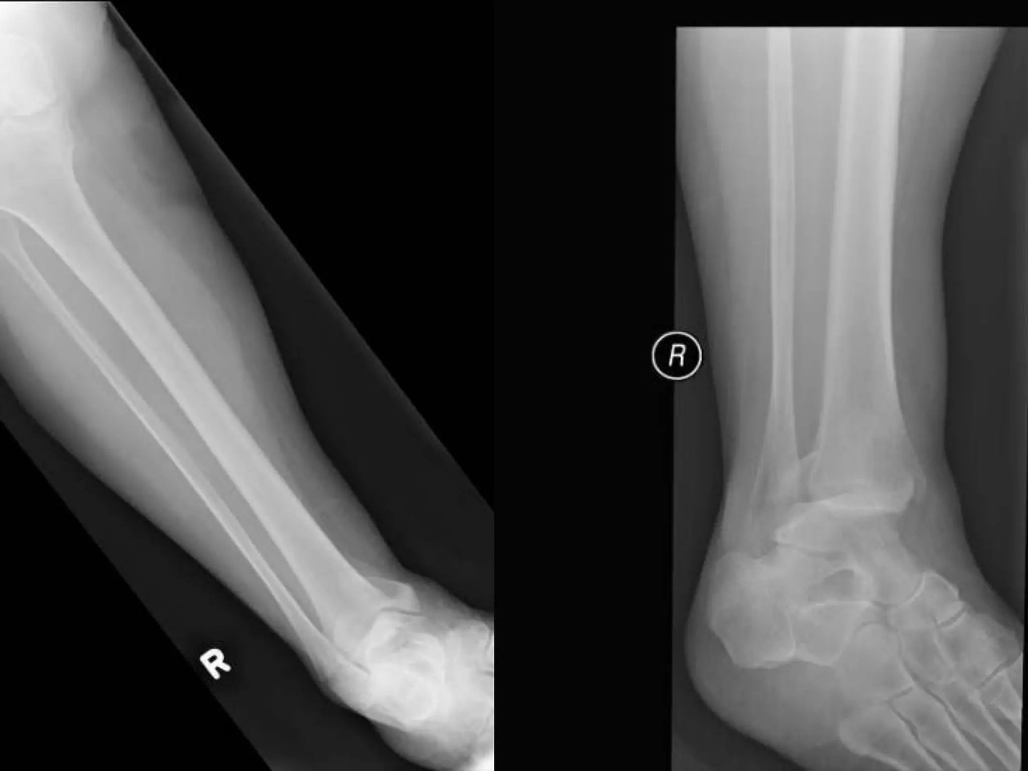 Ankle joint radiography | PPTX