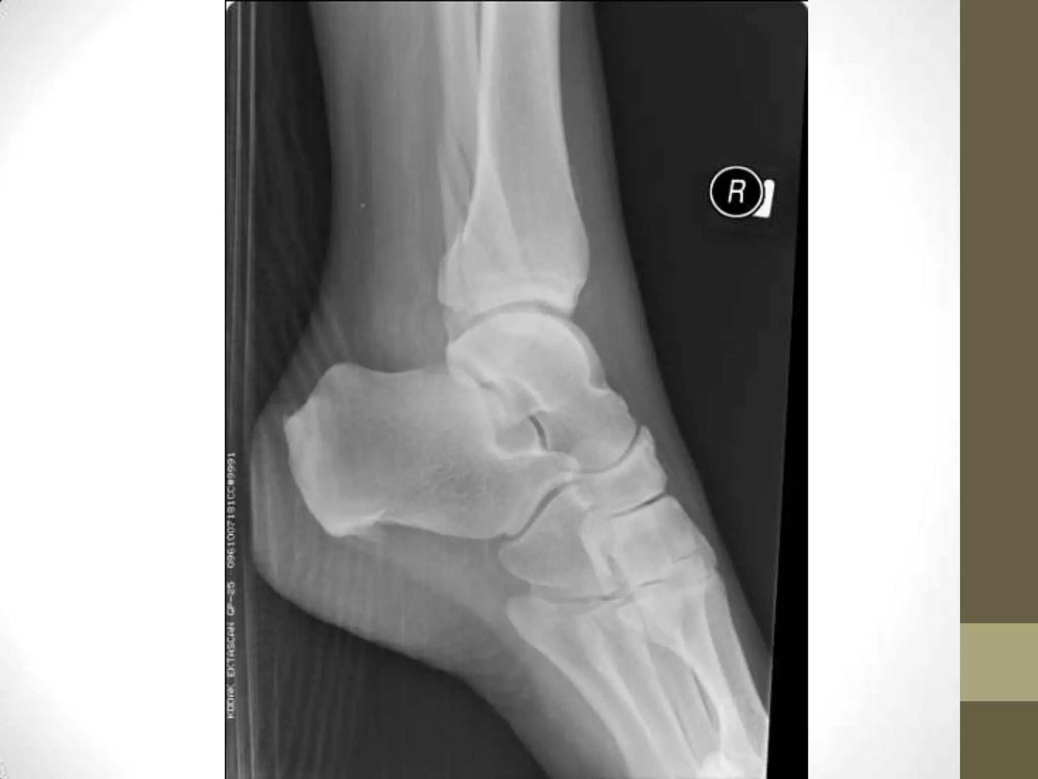 Ankle joint radiography | PPTX
