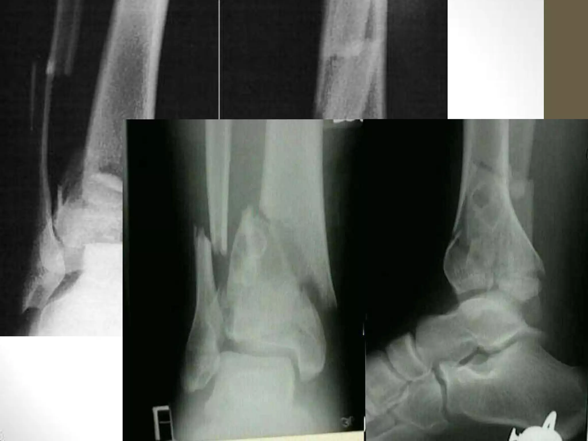 Ankle joint radiography | PPTX
