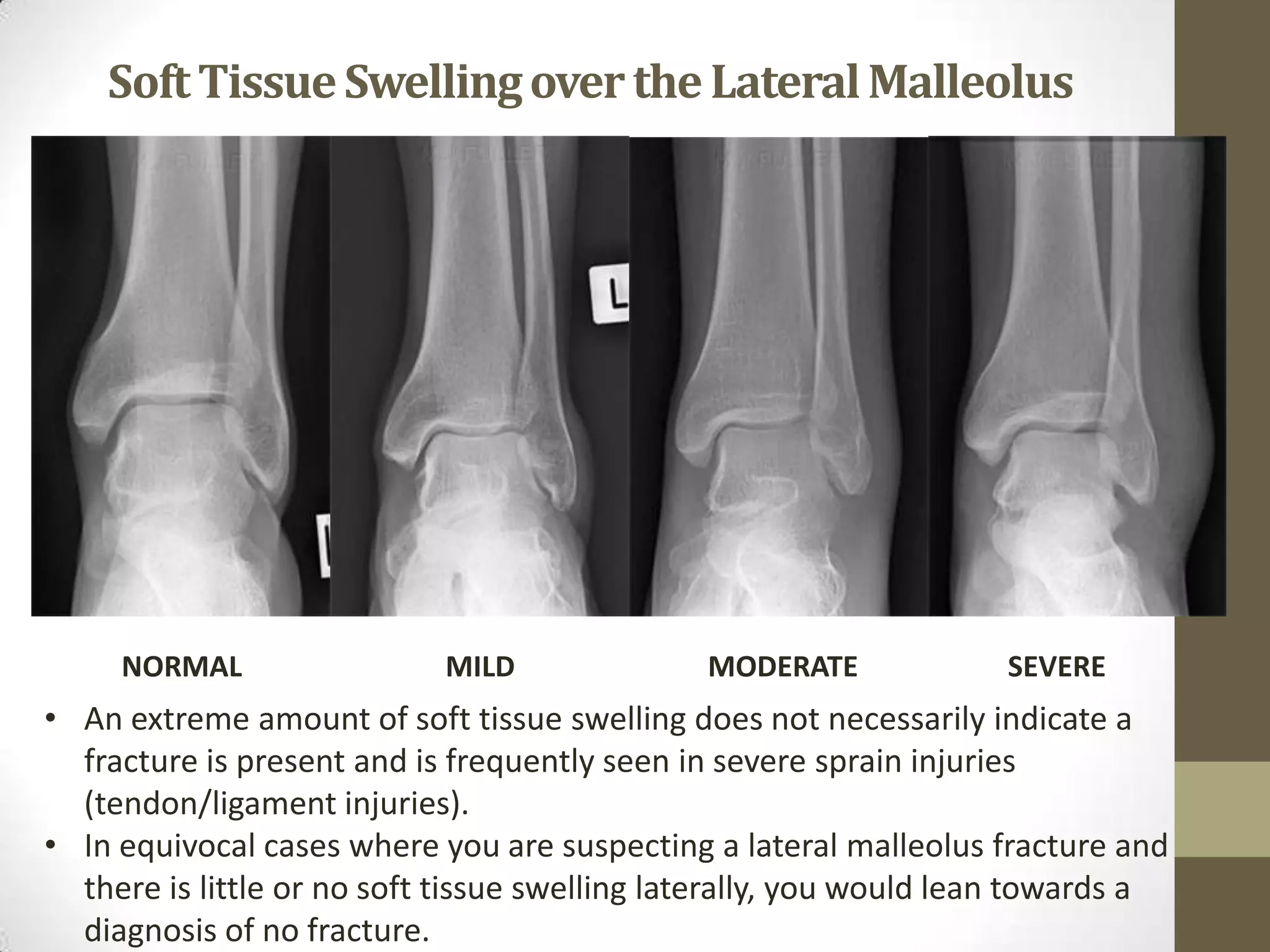 Ankle joint radiography | PPTX