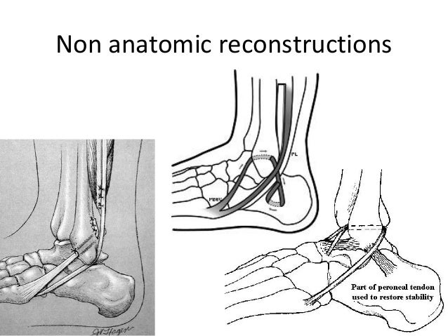 Ankle ligament injuries - Derek Park