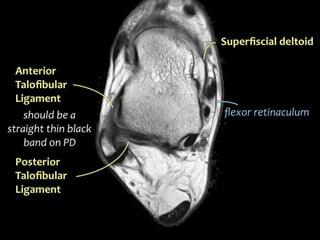 Anterior Talofibular Ligament Mri