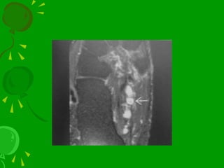 Overuse syndromes of Ankle joint .ppt