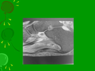 Overuse syndromes of Ankle joint .ppt